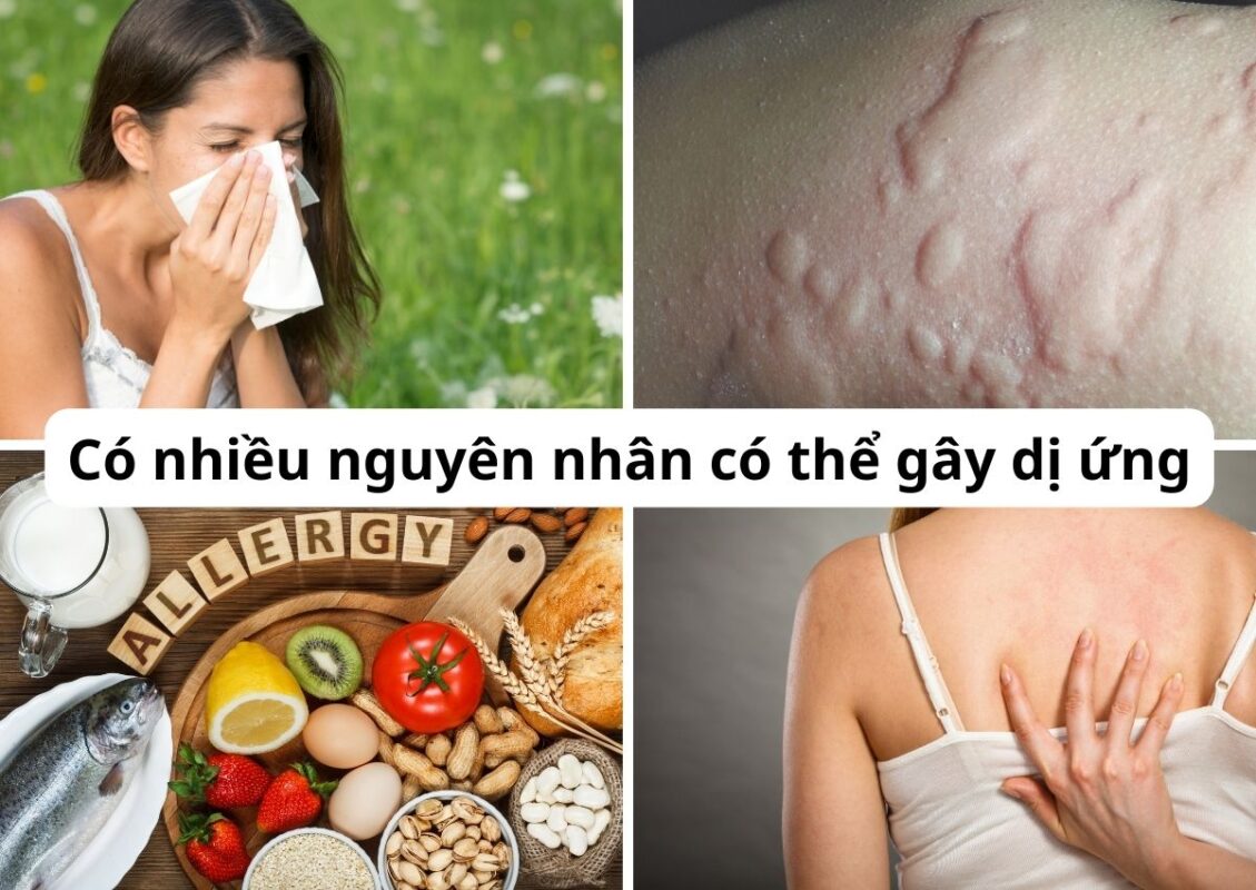 Các loại thuốc dị ứng hiệu quả, thông dụng hiện nay - Dược sĩ Lưu Văn Hoàng